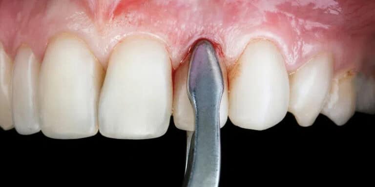 How to Stop Bleeding After Tooth Extraction: Effective Tips and Remedies