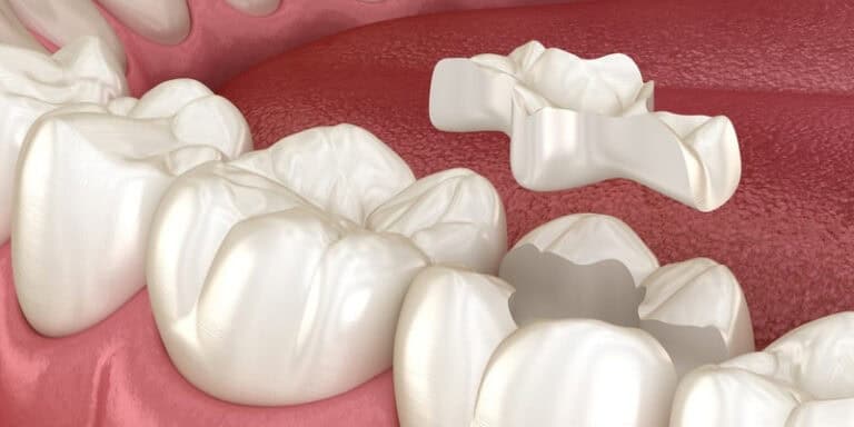 RCT Teeth Cap Prices In India: A Comprehensive Guide