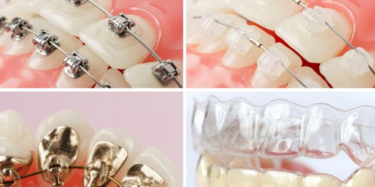 The Different Types of Dental Braces: What’s Best for You?